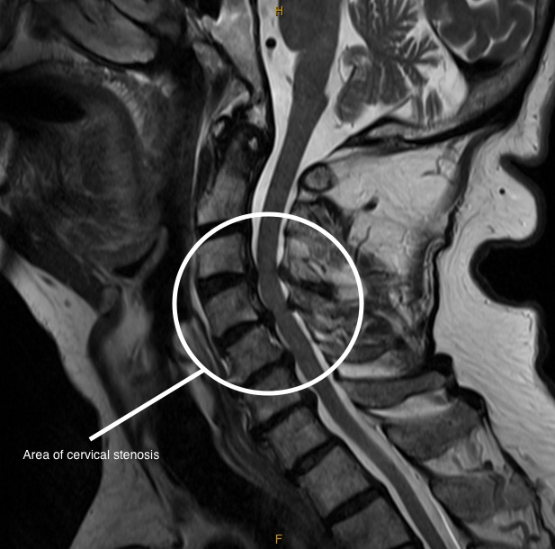 Understanding Cervical Spinal Stenosis and Myelopathy