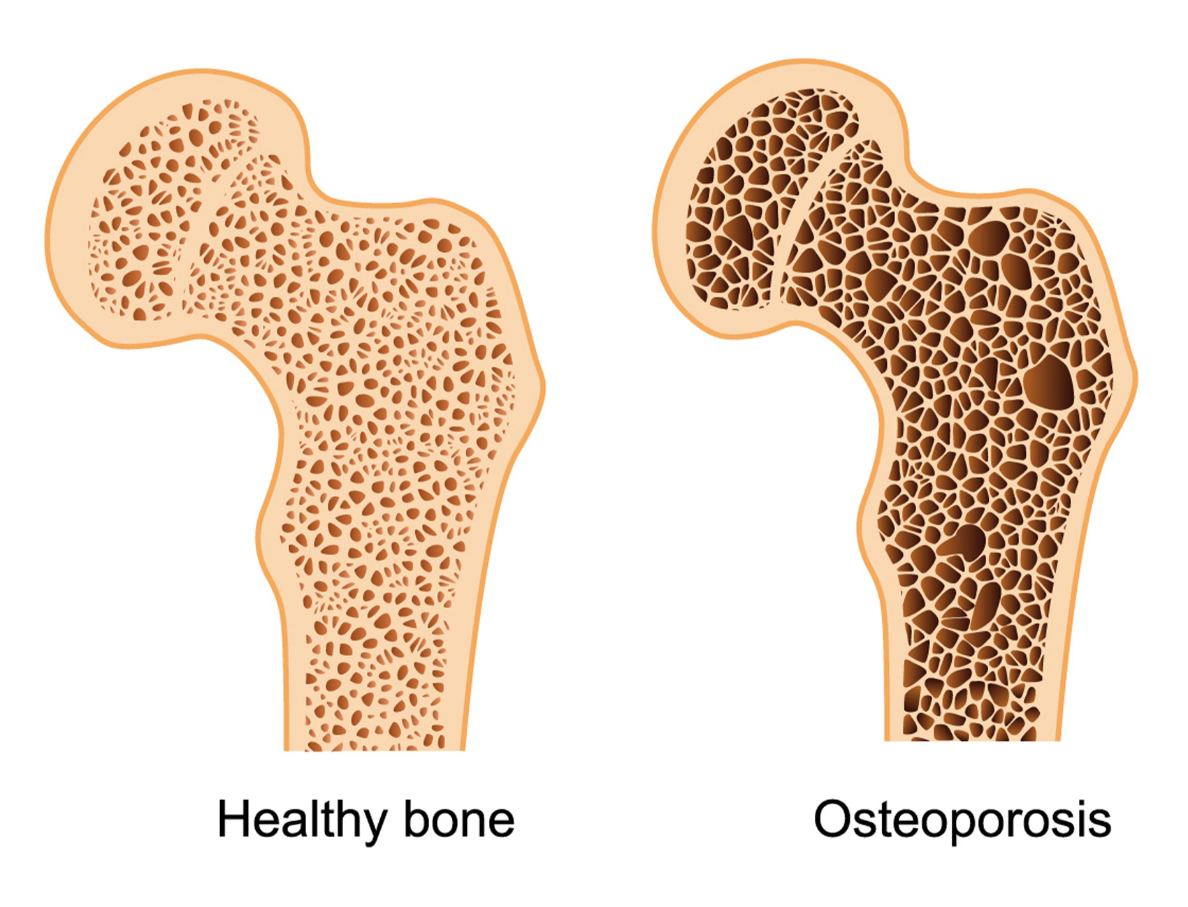 Osteoporosis and Bone Health
